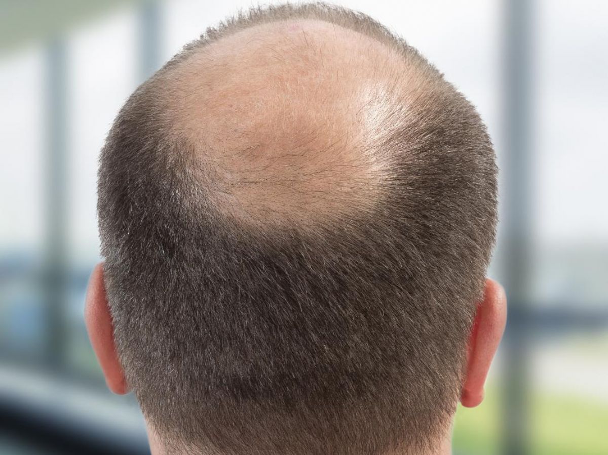 Quels sont les stades et traitements de la calvitie chez l’homme