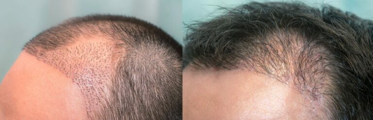Greffe de Cheveux Sans Rasage | Technique FUE Discrète près de Paris